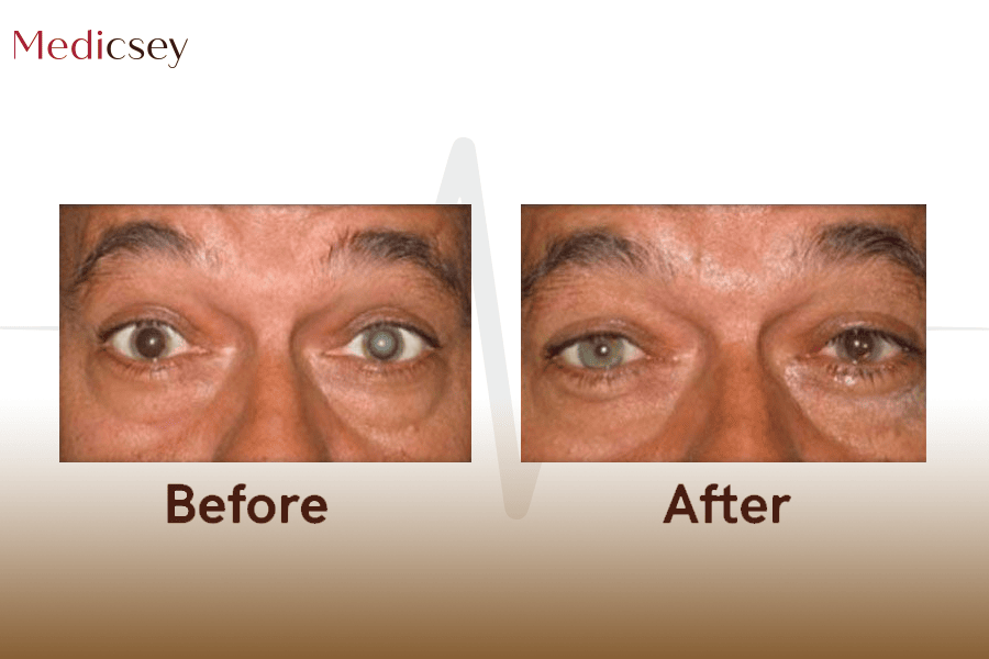 Lens Replacement Surgery in Turkey | Medicsey